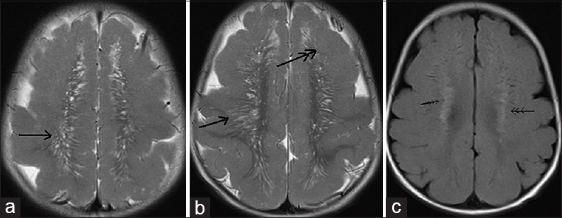 Technical Info on Pachygyria and Lissencephaly Levels – Making ...